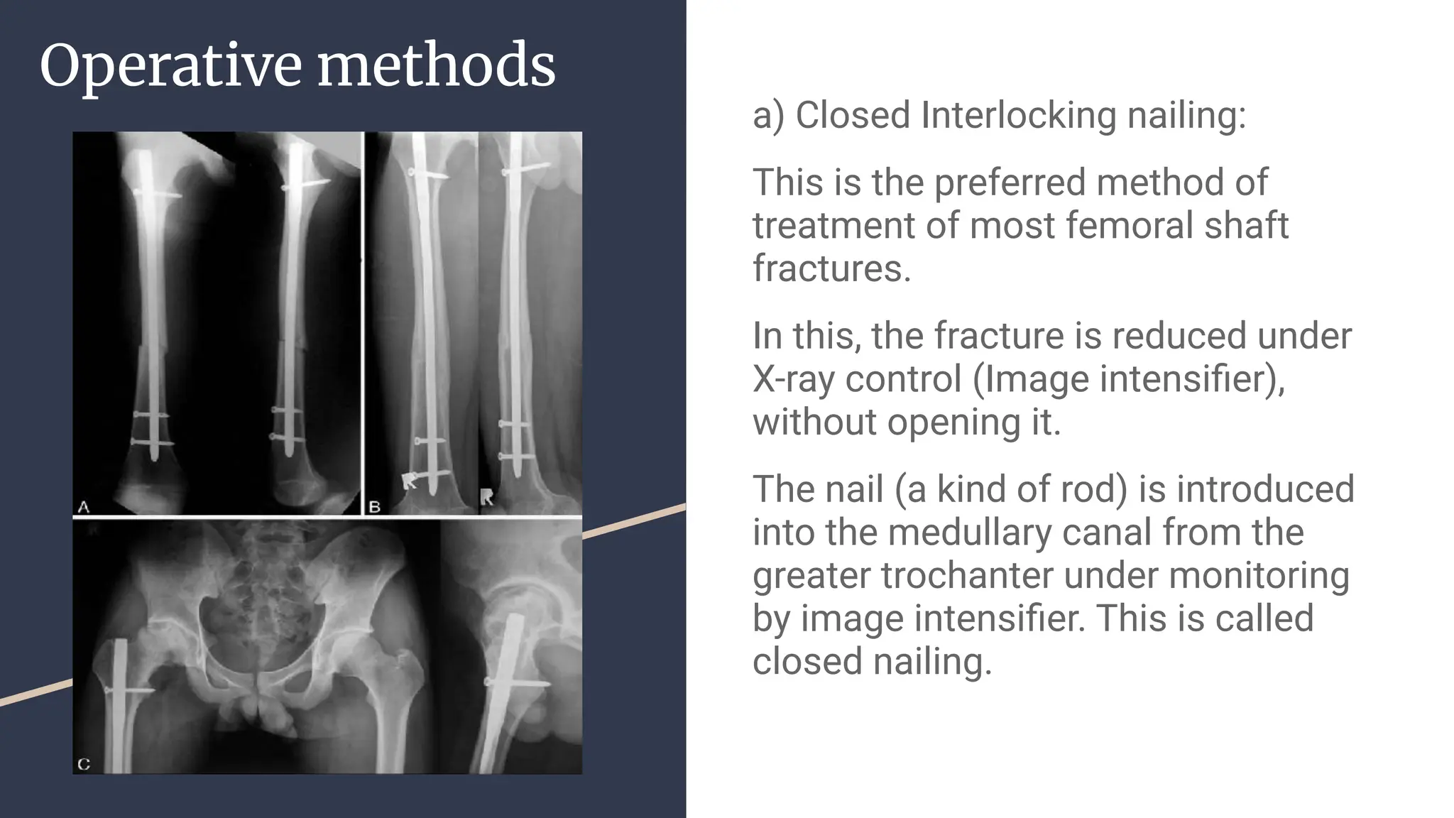TREATMENT OF SHAFT OF FEMUR FRACTURE IN ADULTS.pdf
