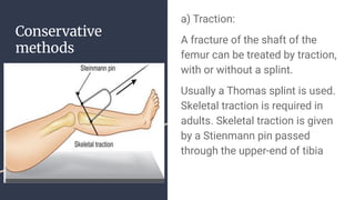 TREATMENT OF SHAFT OF FEMUR FRACTURE IN ADULTS.pdf