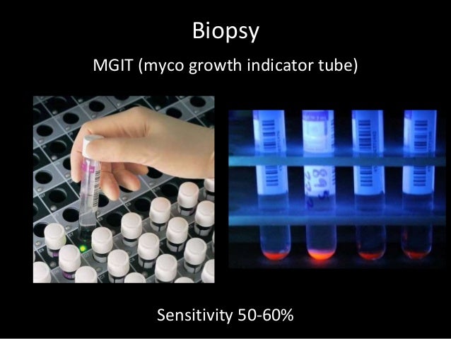 Treatment of spinal tuberculosis