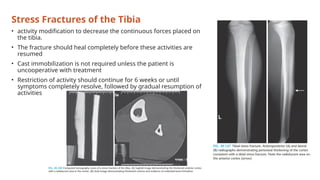 Treatment of Tibia and Fibula Fractures.pptx