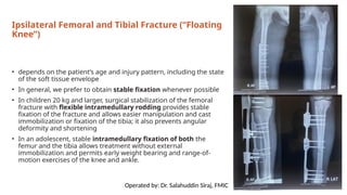 Treatment of Tibia and Fibula Fractures.pptx