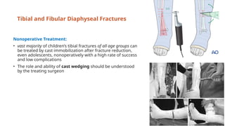 Treatment of Tibia and Fibula Fractures.pptx