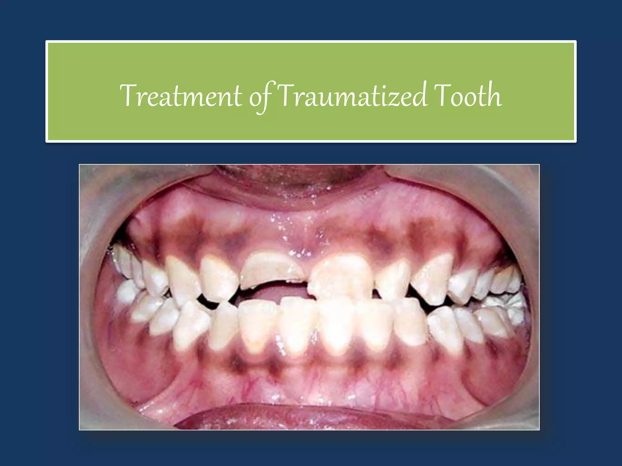 Treatment of traumatised tooth | PPTX