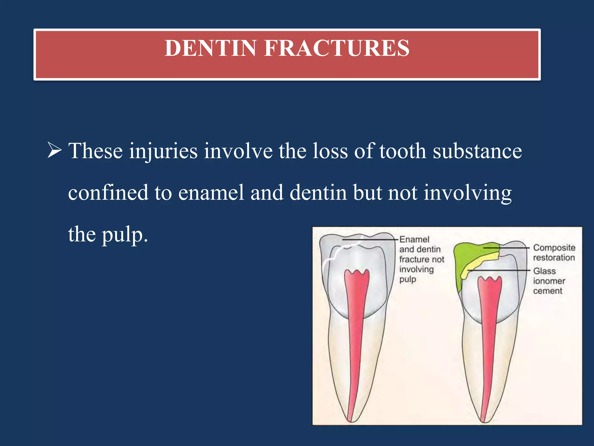 Treatment of traumatised tooth | PPTX