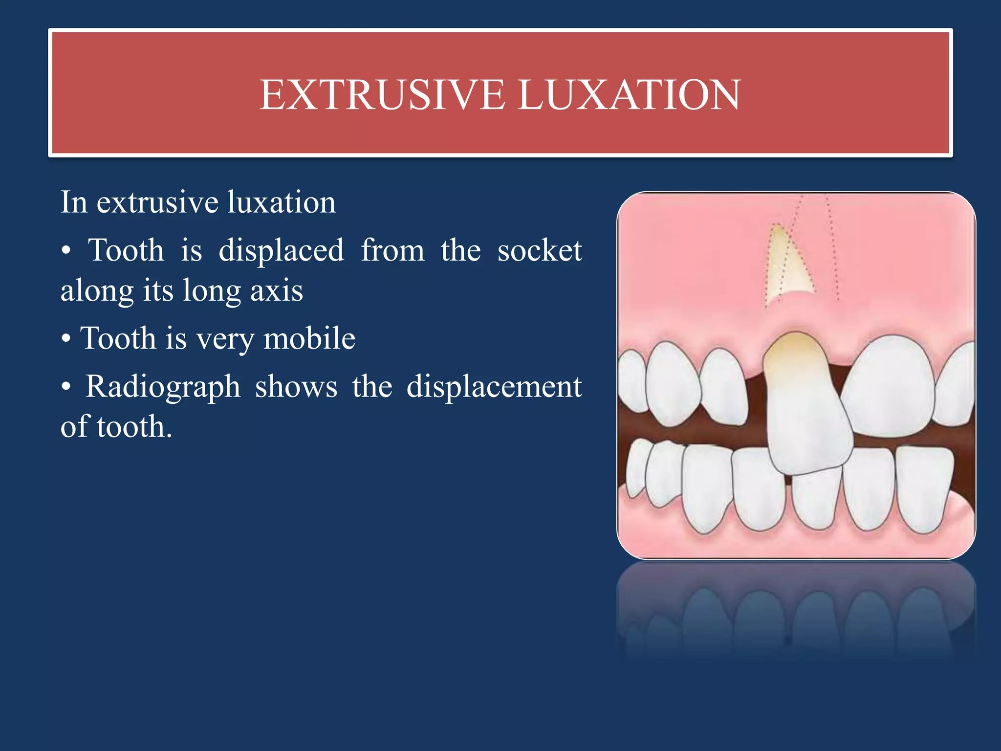 Treatment of traumatised tooth | PPTX
