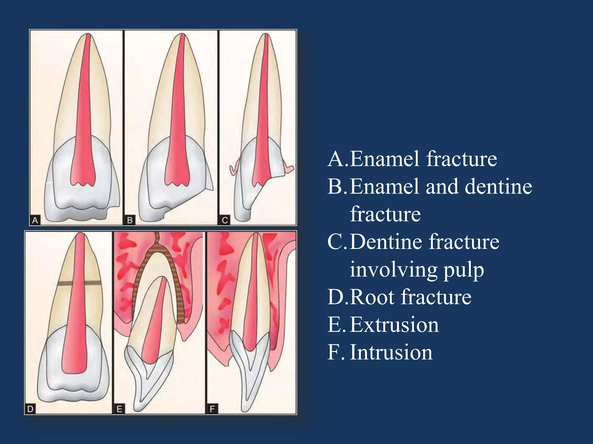 Treatment of traumatised tooth | PPTX