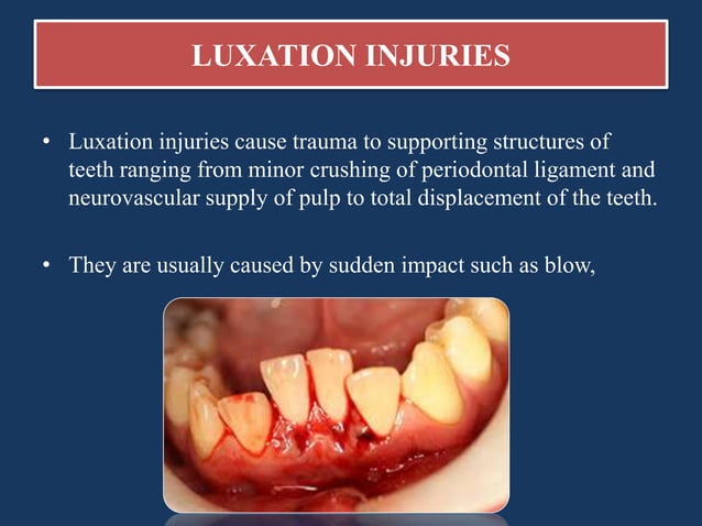 Treatment of traumatised tooth | PPTX | Death, Injury, or Military ...