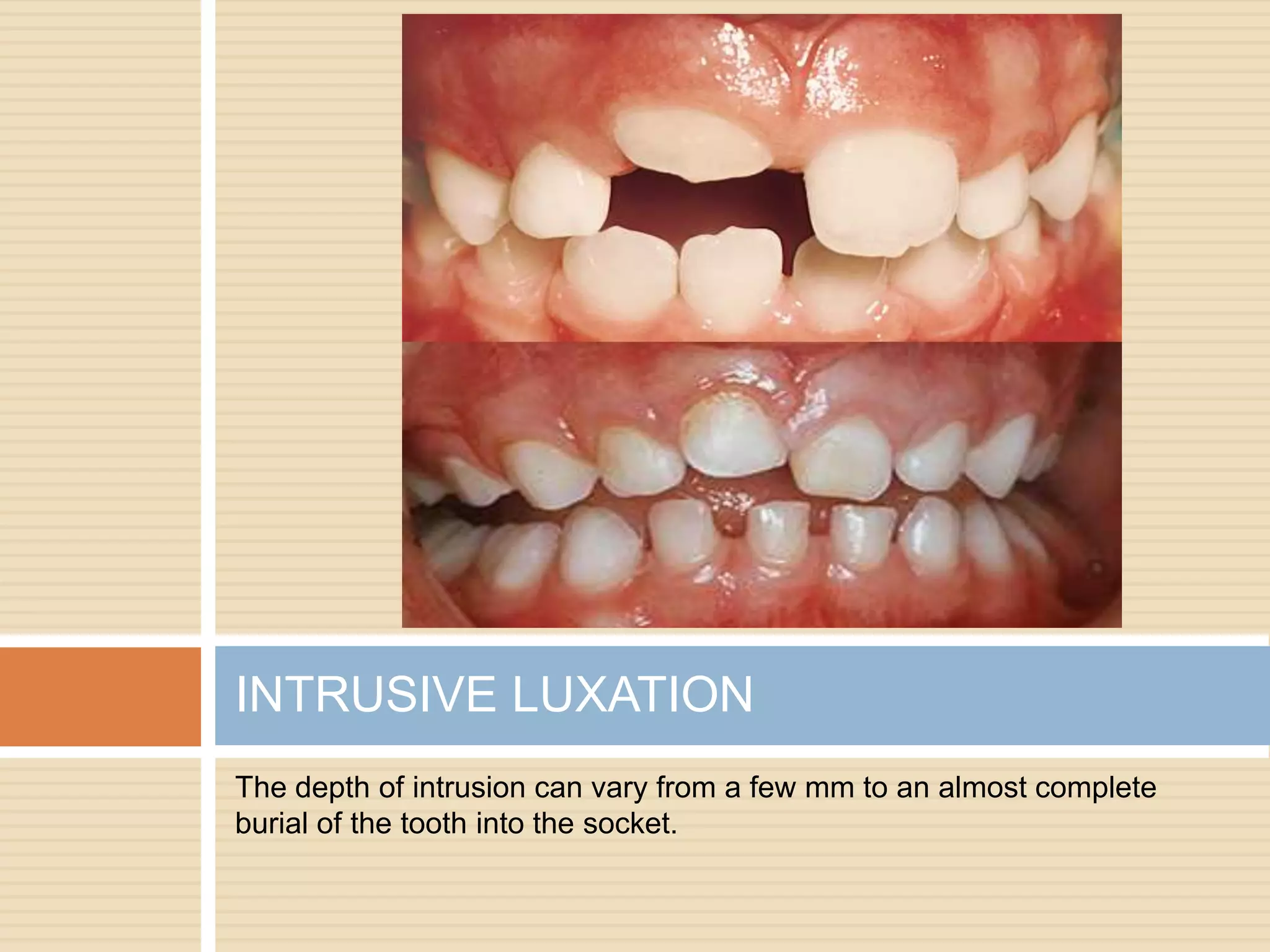 Treatment of Traumatized Teeth | PPTX
