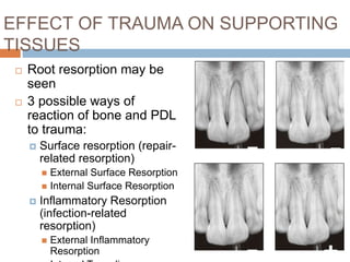 Treatment of Traumatized Teeth | PPTX