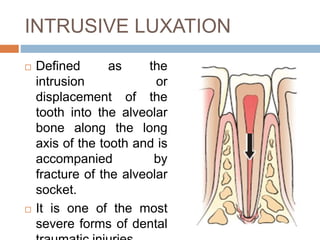 Treatment of Traumatized Teeth | PPTX