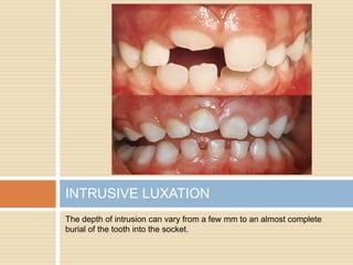 Treatment of Traumatized Teeth | PPTX