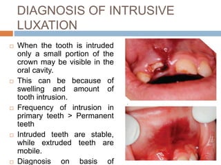 Treatment of Traumatized Teeth | PPT