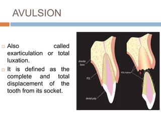 Treatment of Traumatized Teeth | PPTX