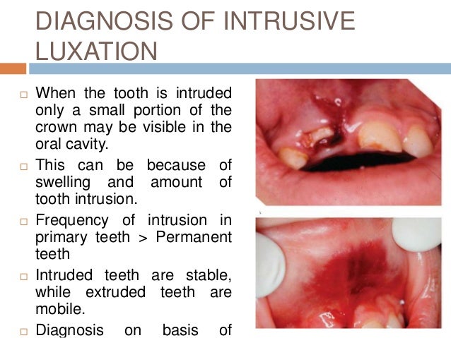 Treatment of Traumatized Teeth