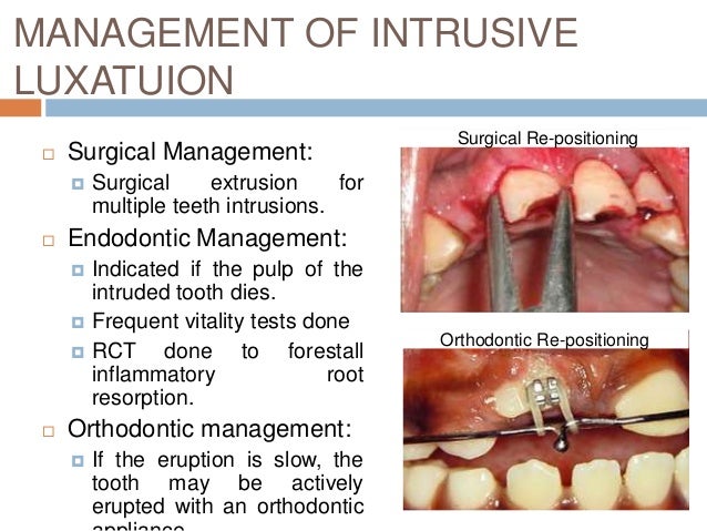 Treatment of Traumatized Teeth