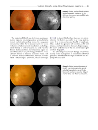Treatment options for central retinal artery occlusion 2012 | PDF