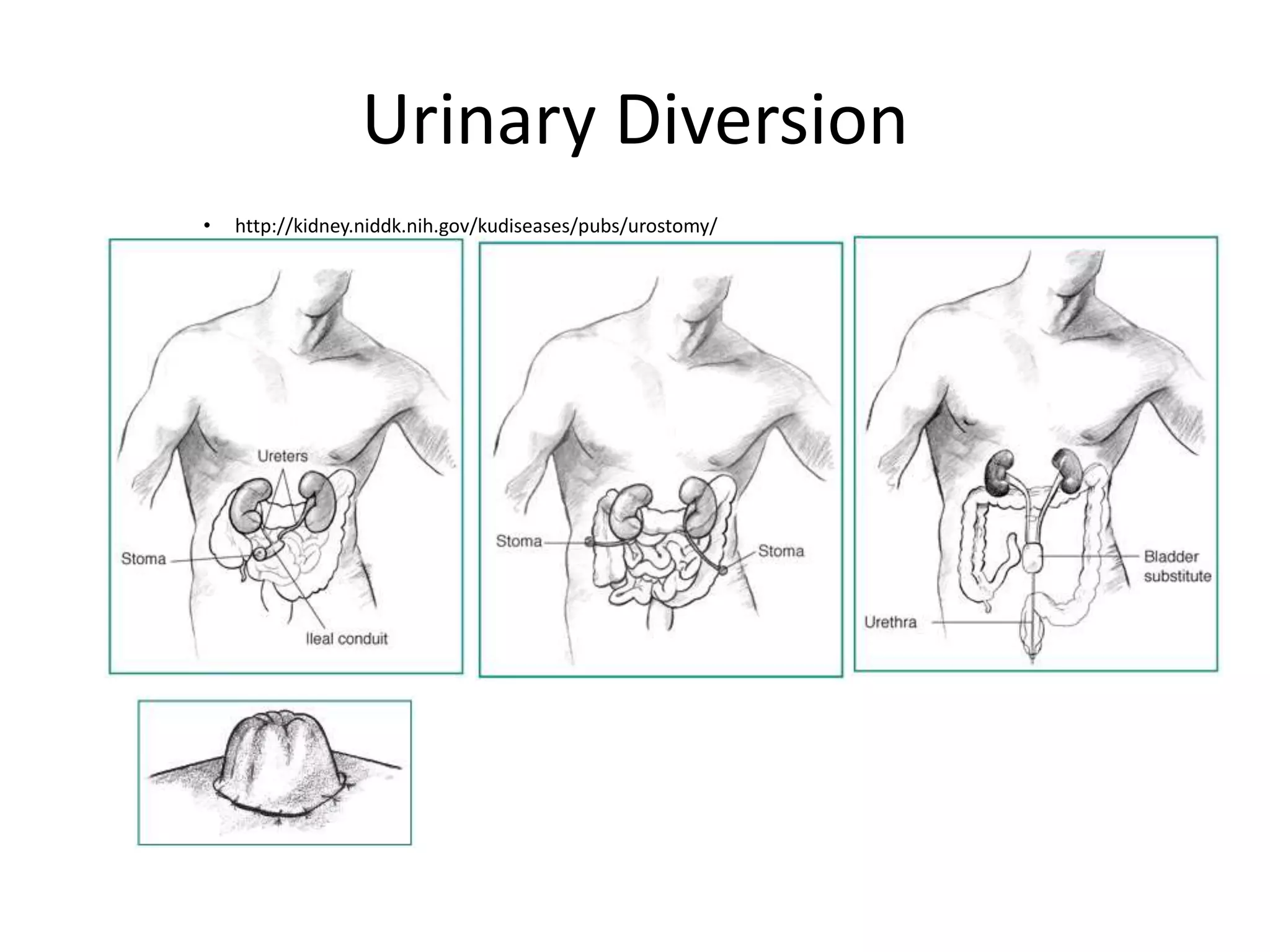 Treatment options for invasive bladder carcinoma | PPTX