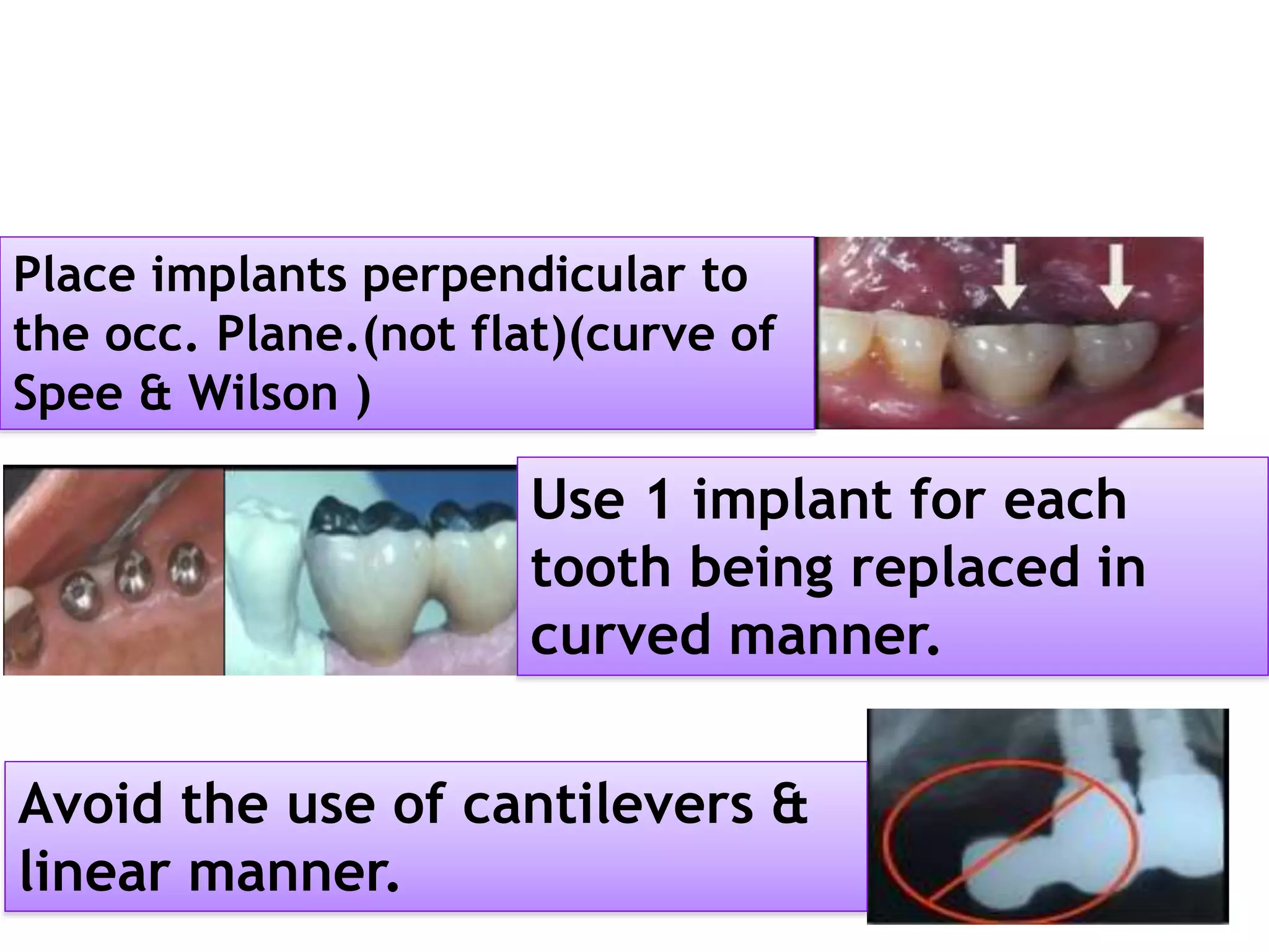 Treatment plan and biological consideration of implants | PPT