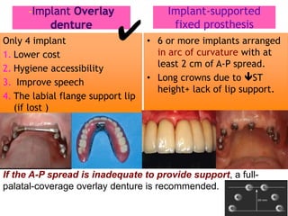 Treatment plan and biological consideration of implants | PPT