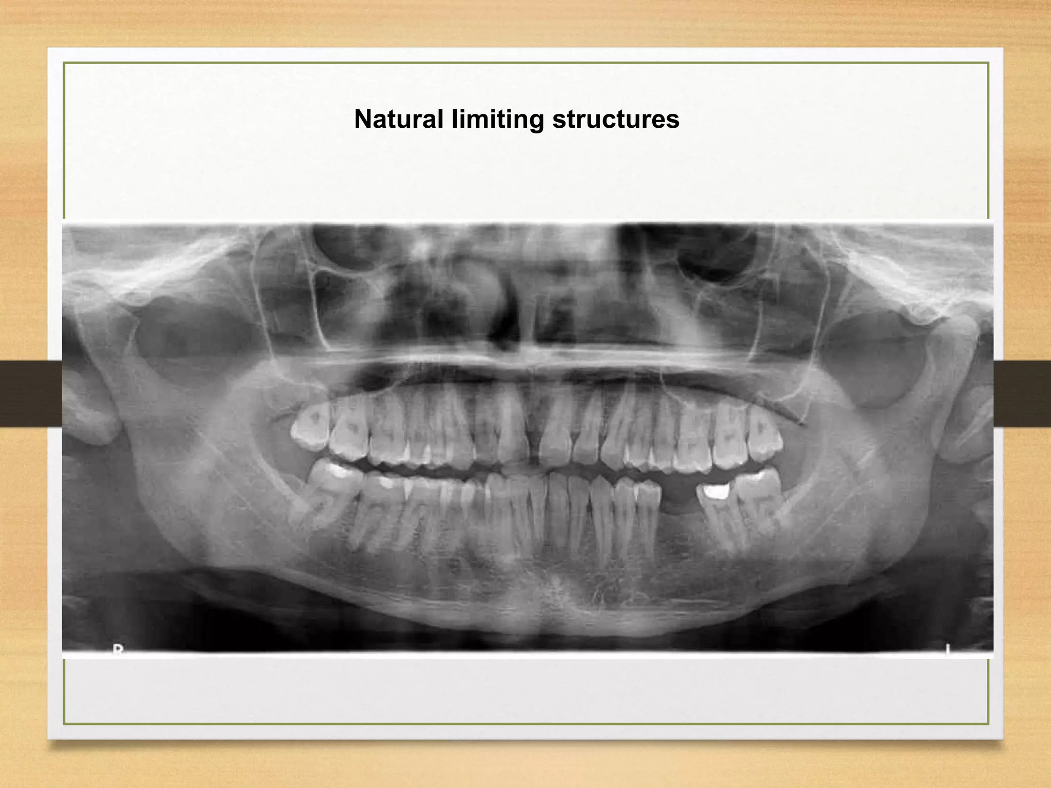 Treatment planning for basal implants | PPT