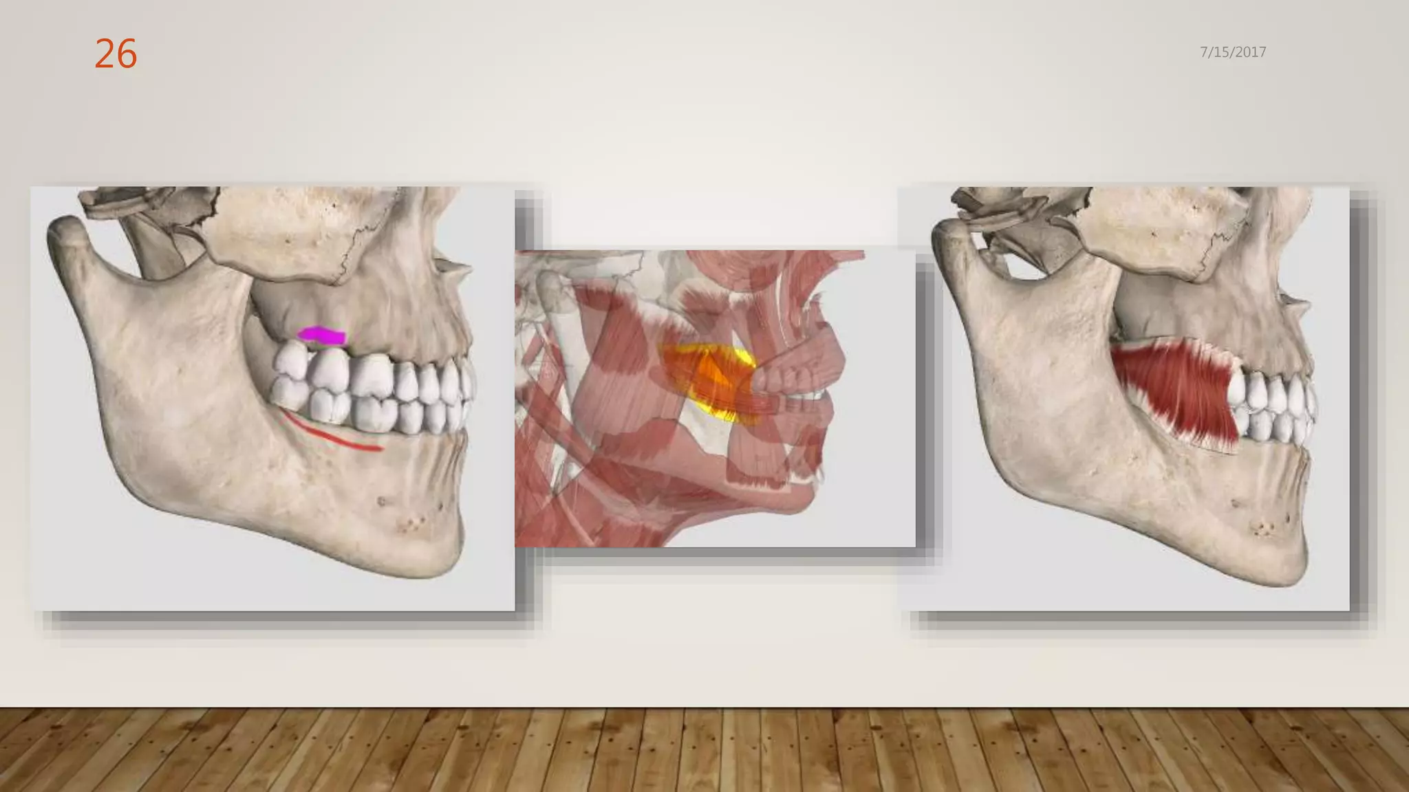 Treatment planning in posterior mandible | PPTX | Dental Health ...