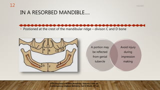 Treatment planning in posterior mandible | PPTX