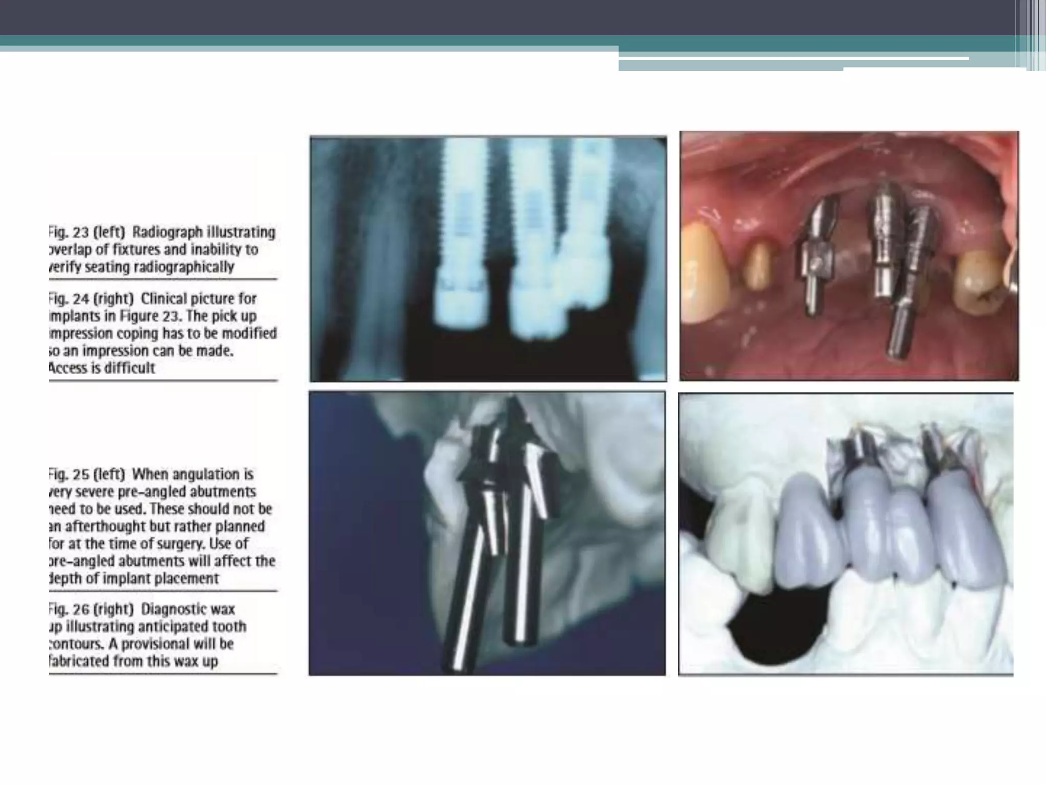 Treatment Planning of Implants in Posterior Quadrants | PPTX