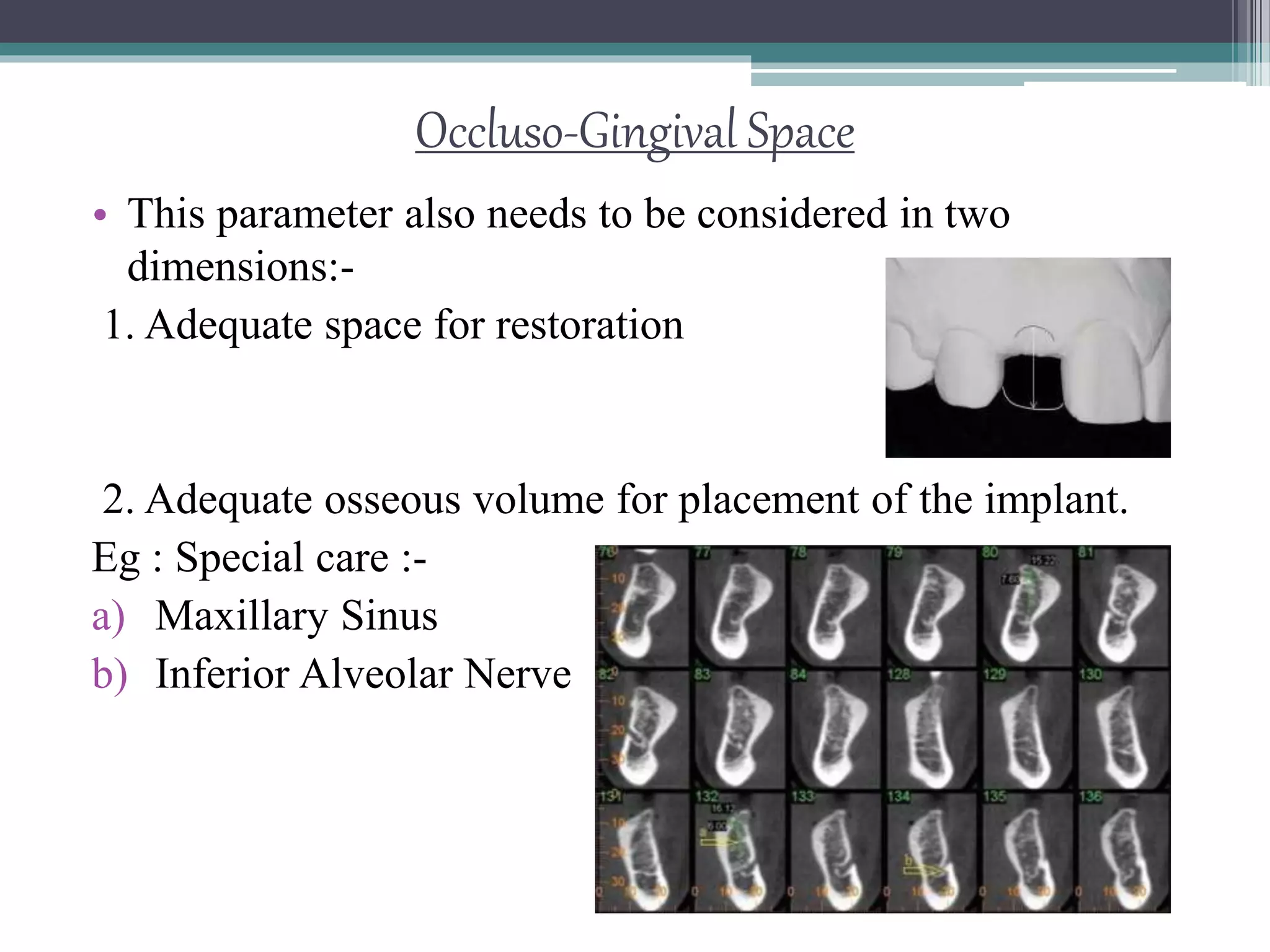Treatment Planning of Implants in Posterior Quadrants | PPTX