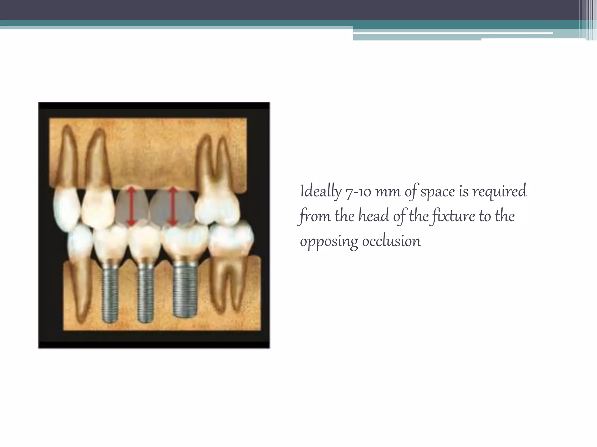 Treatment Planning of Implants in Posterior Quadrants | PPTX