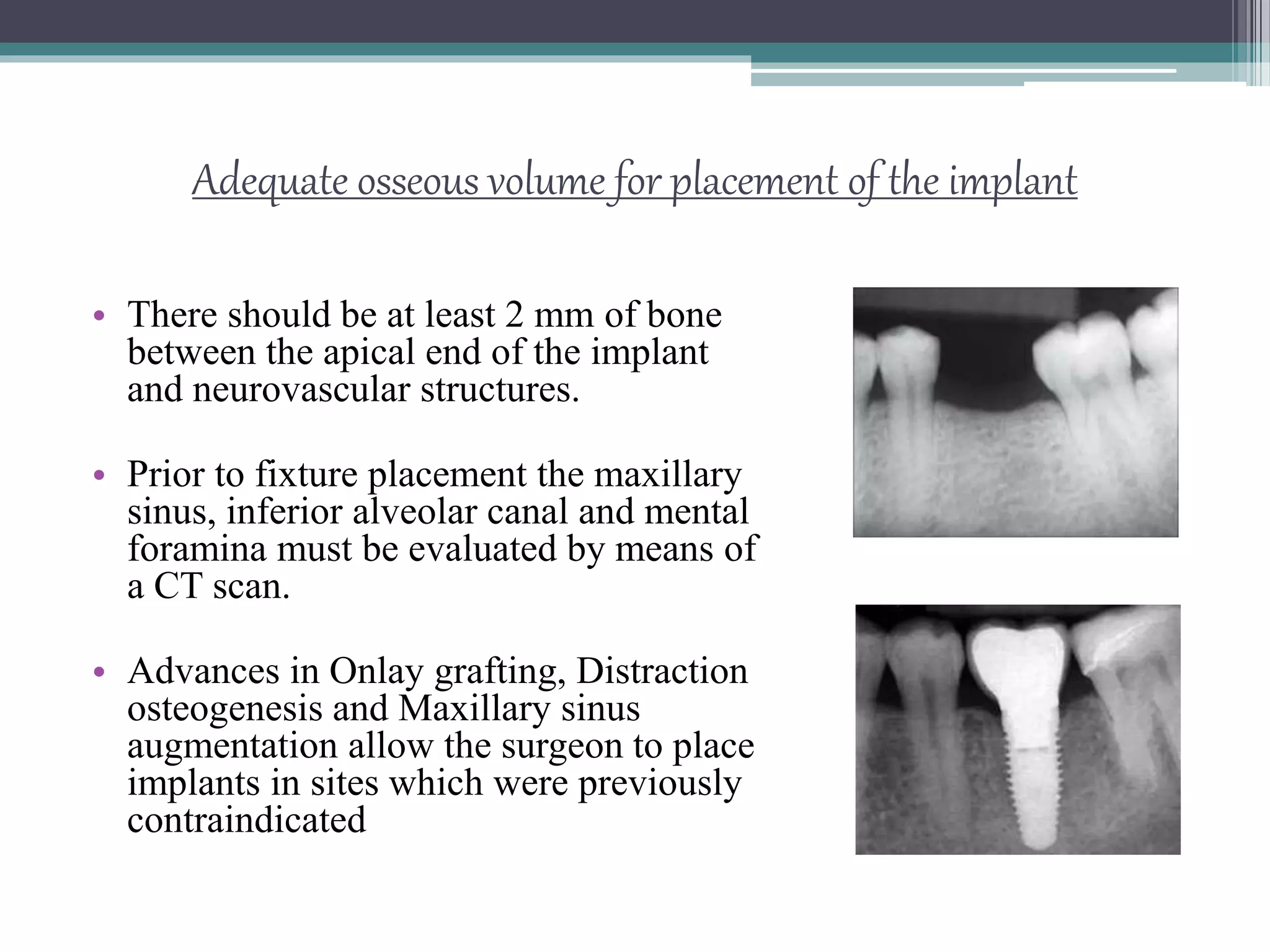 Treatment Planning of Implants in Posterior Quadrants | PPTX