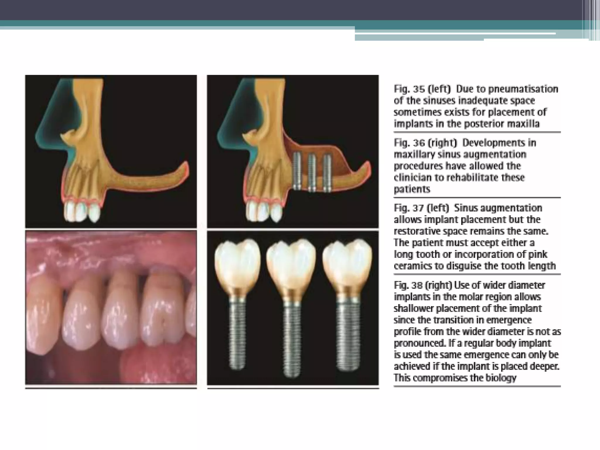 Treatment Planning of Implants in Posterior Quadrants | PPTX