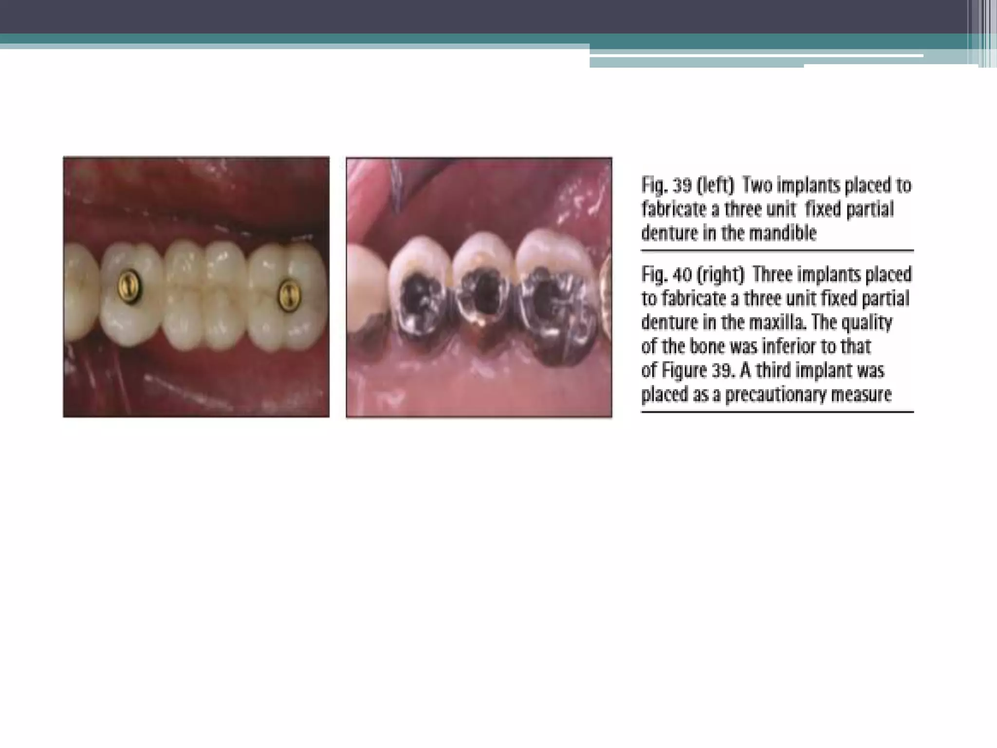 Treatment Planning of Implants in Posterior Quadrants | PPTX