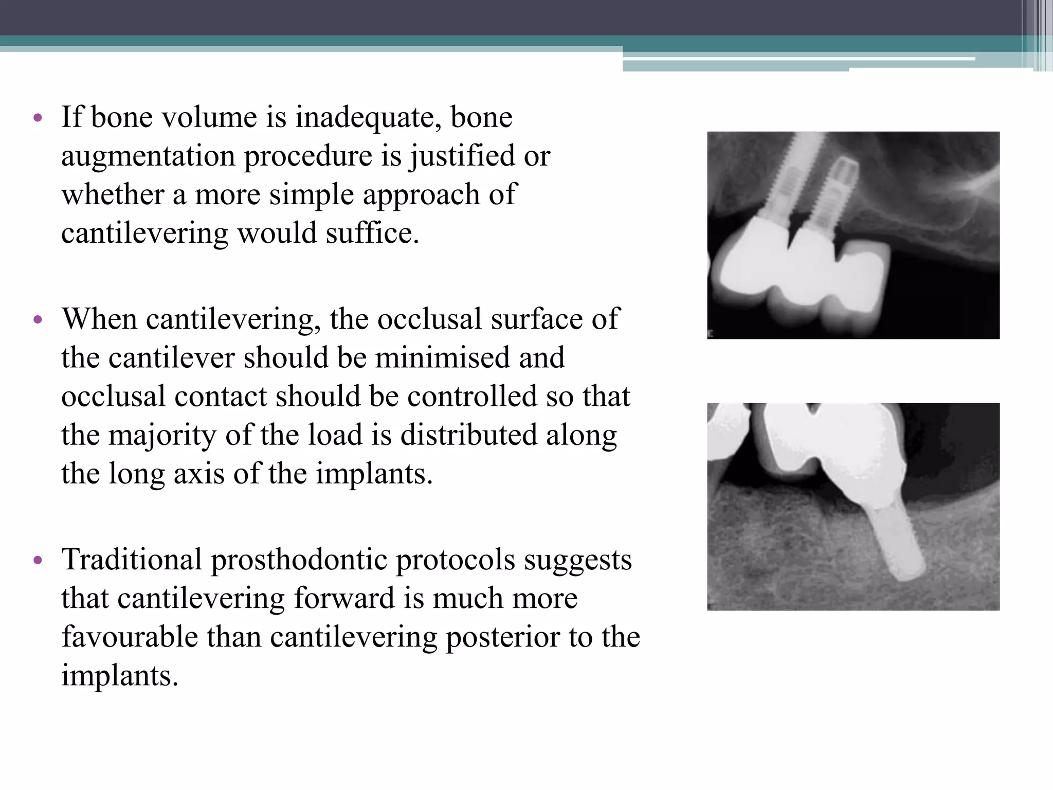 Treatment Planning of Implants in Posterior Quadrants | PPTX