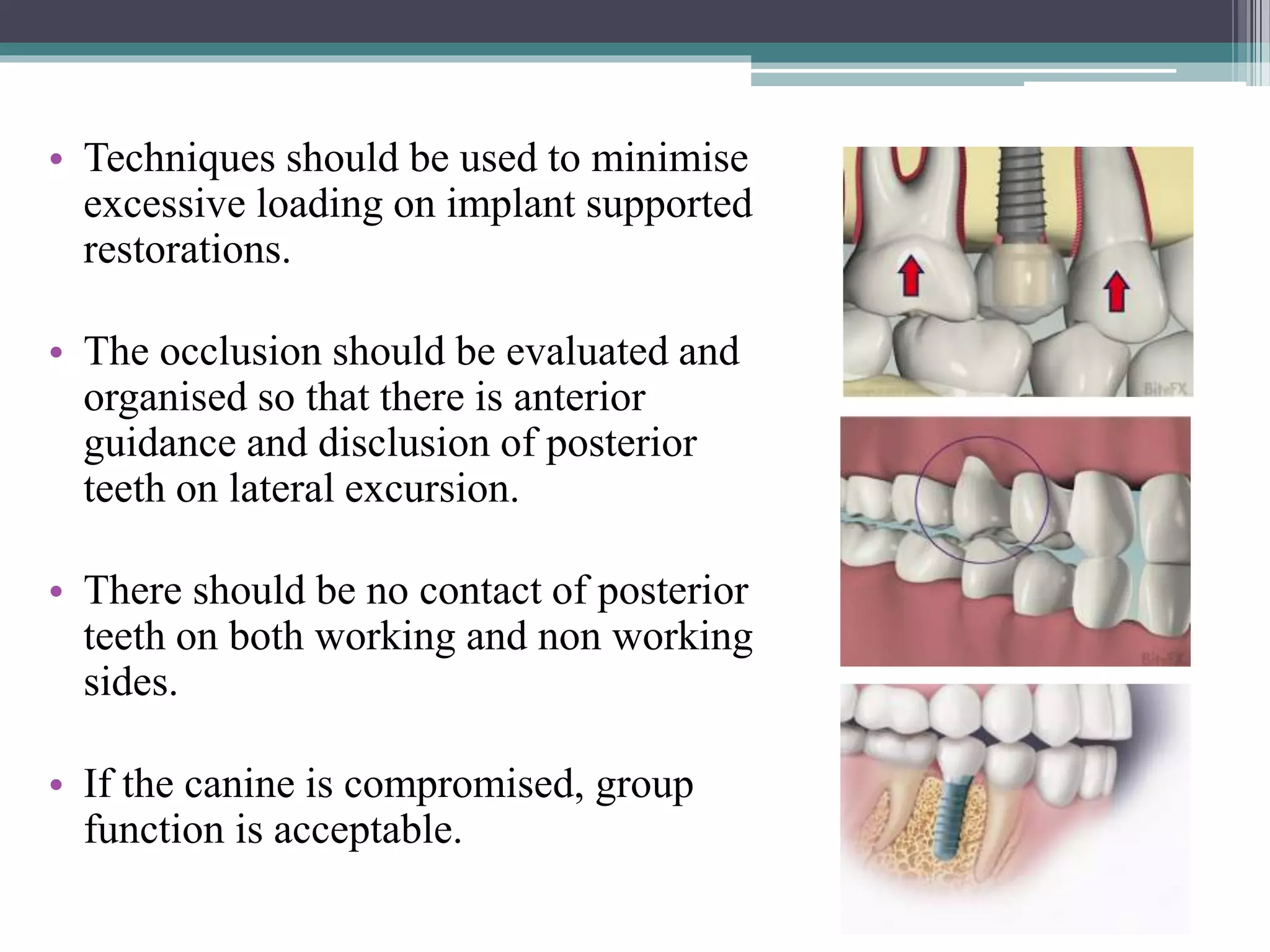 Treatment Planning of Implants in Posterior Quadrants | PPTX