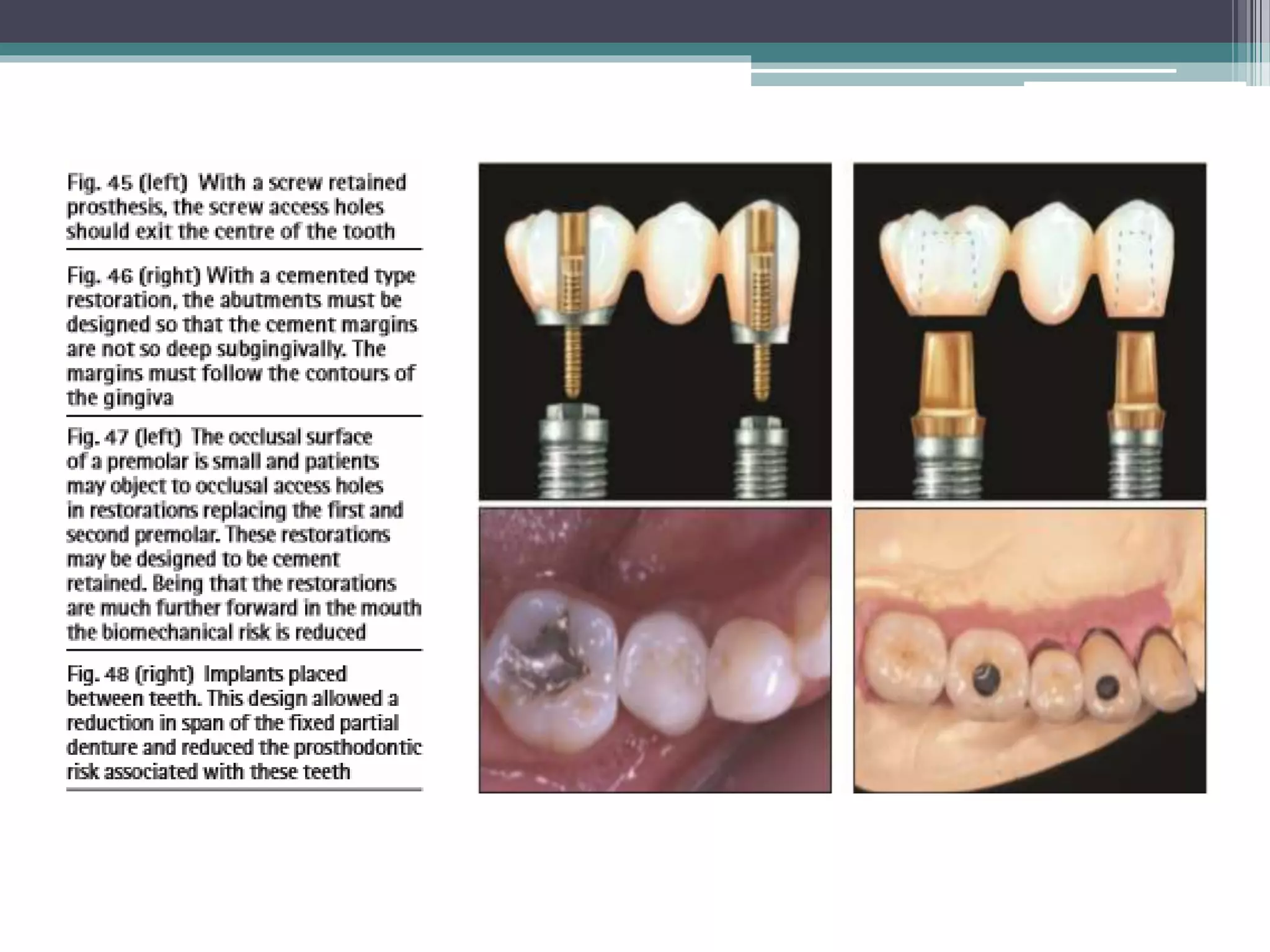 Treatment Planning of Implants in Posterior Quadrants | PPTX