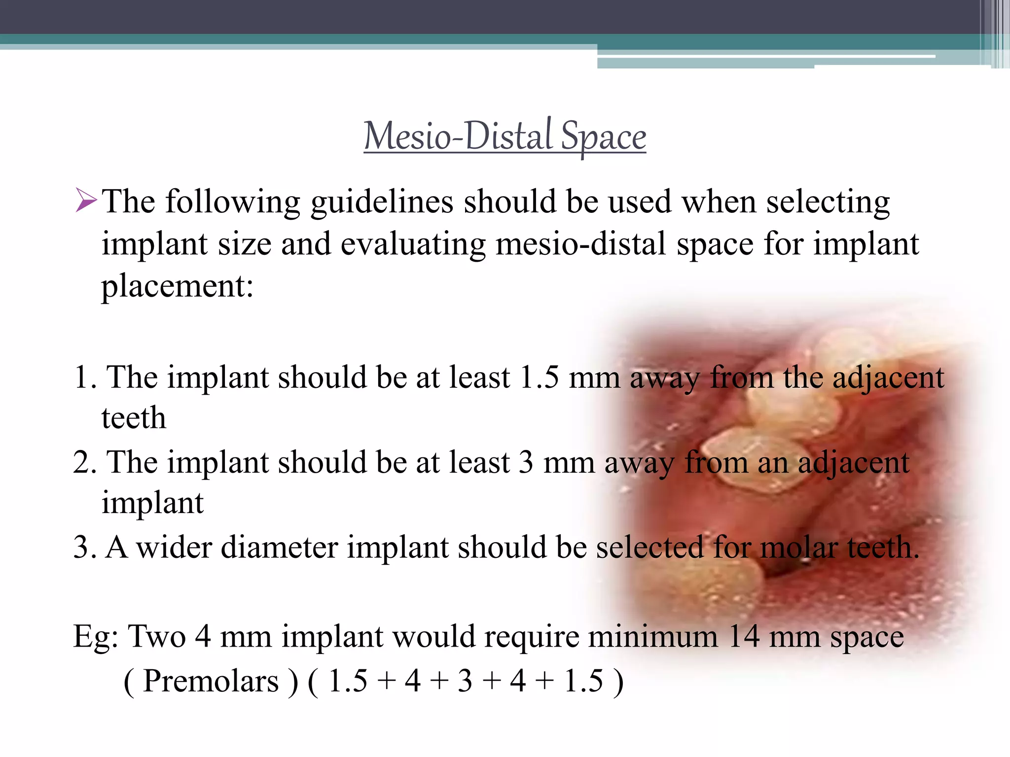 Treatment Planning of Implants in Posterior Quadrants | PPTX