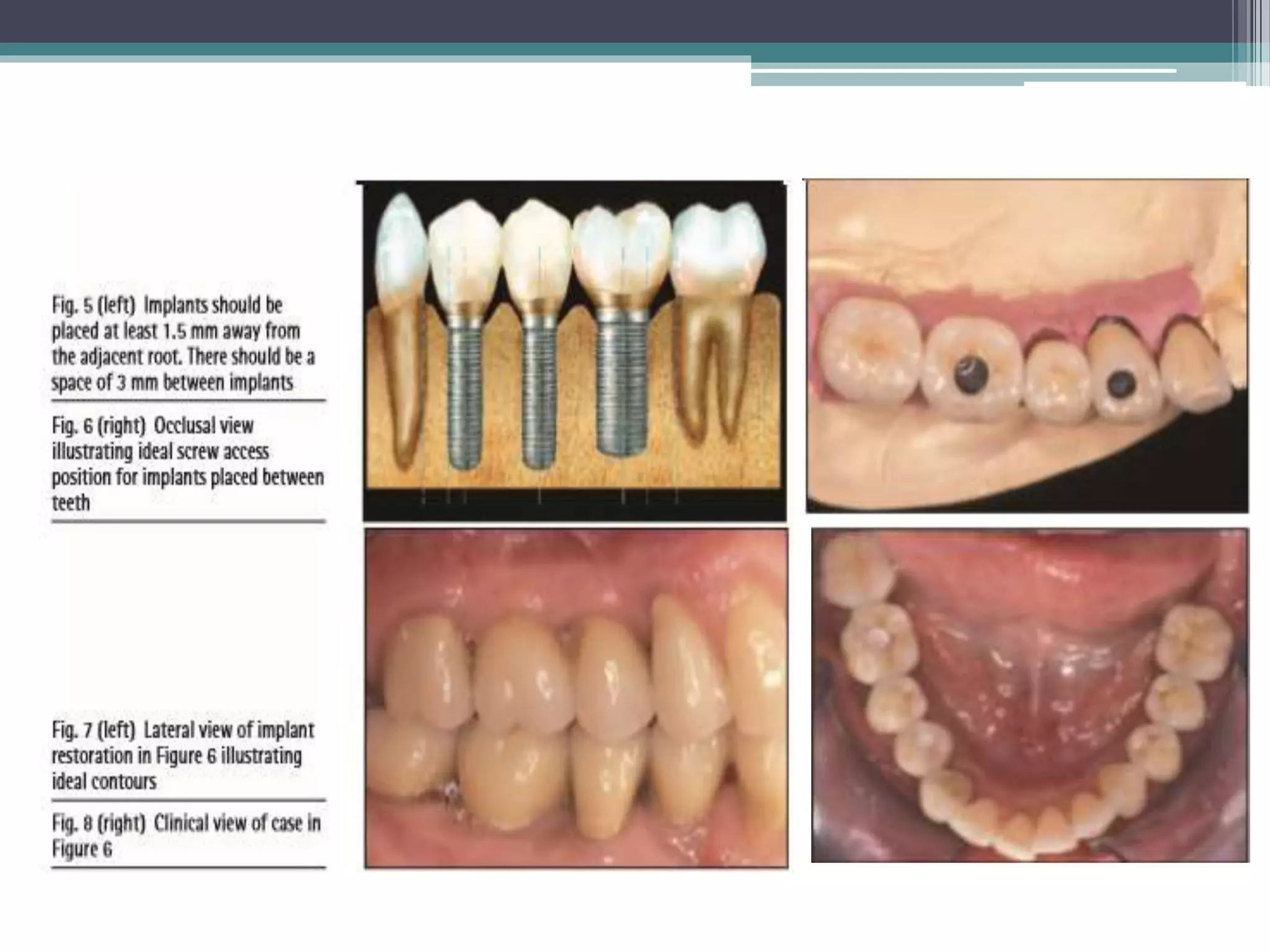 Treatment Planning of Implants in Posterior Quadrants | PPTX
