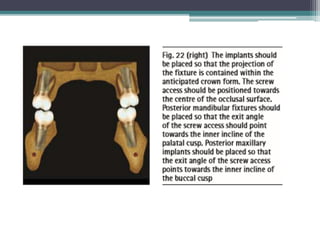 Treatment Planning of Implants in Posterior Quadrants | PPTX