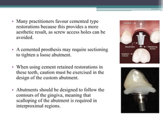 Treatment Planning of Implants in Posterior Quadrants | PPTX