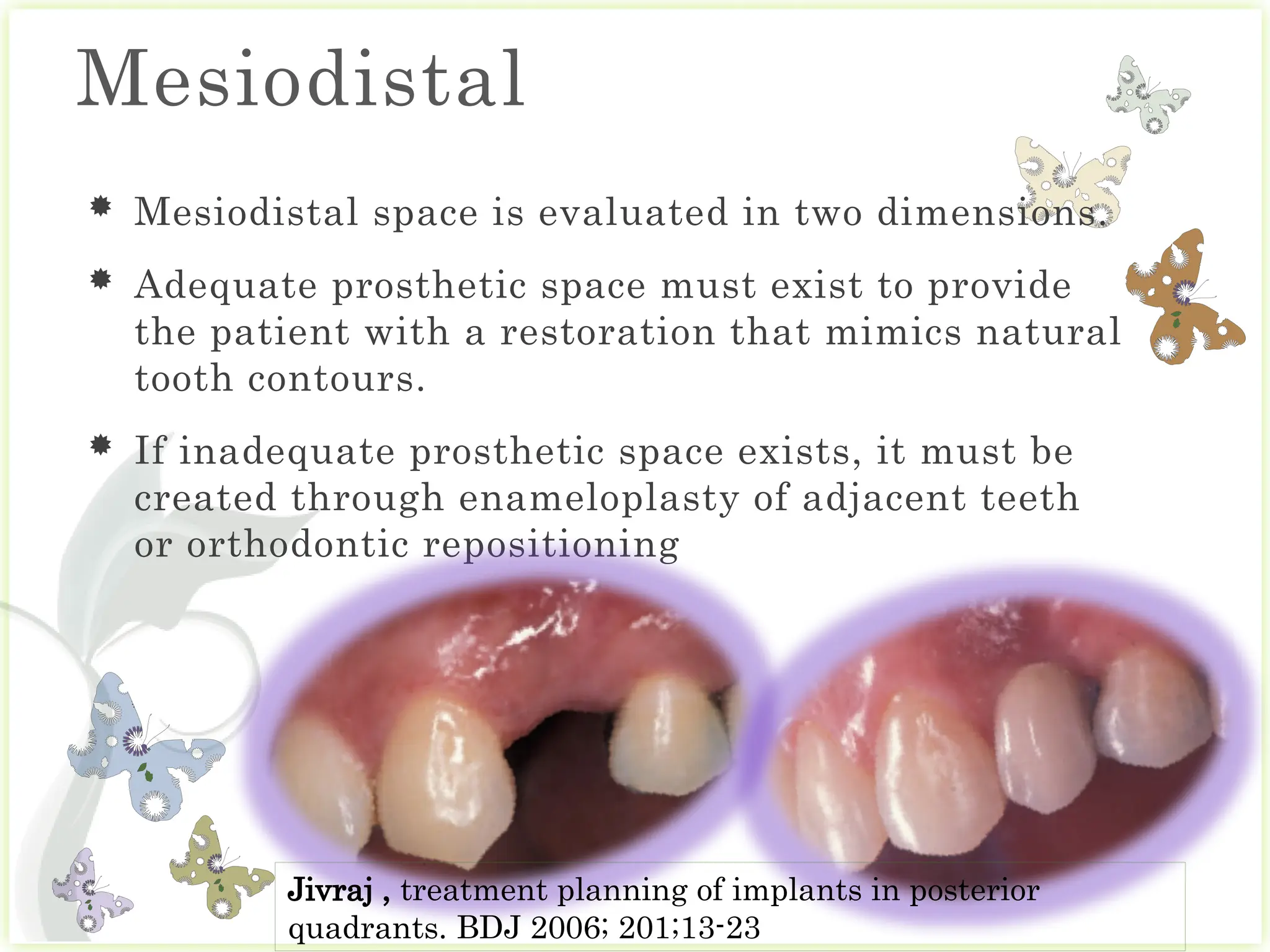 Treatment planning of implants in posterior quadrants.pptx