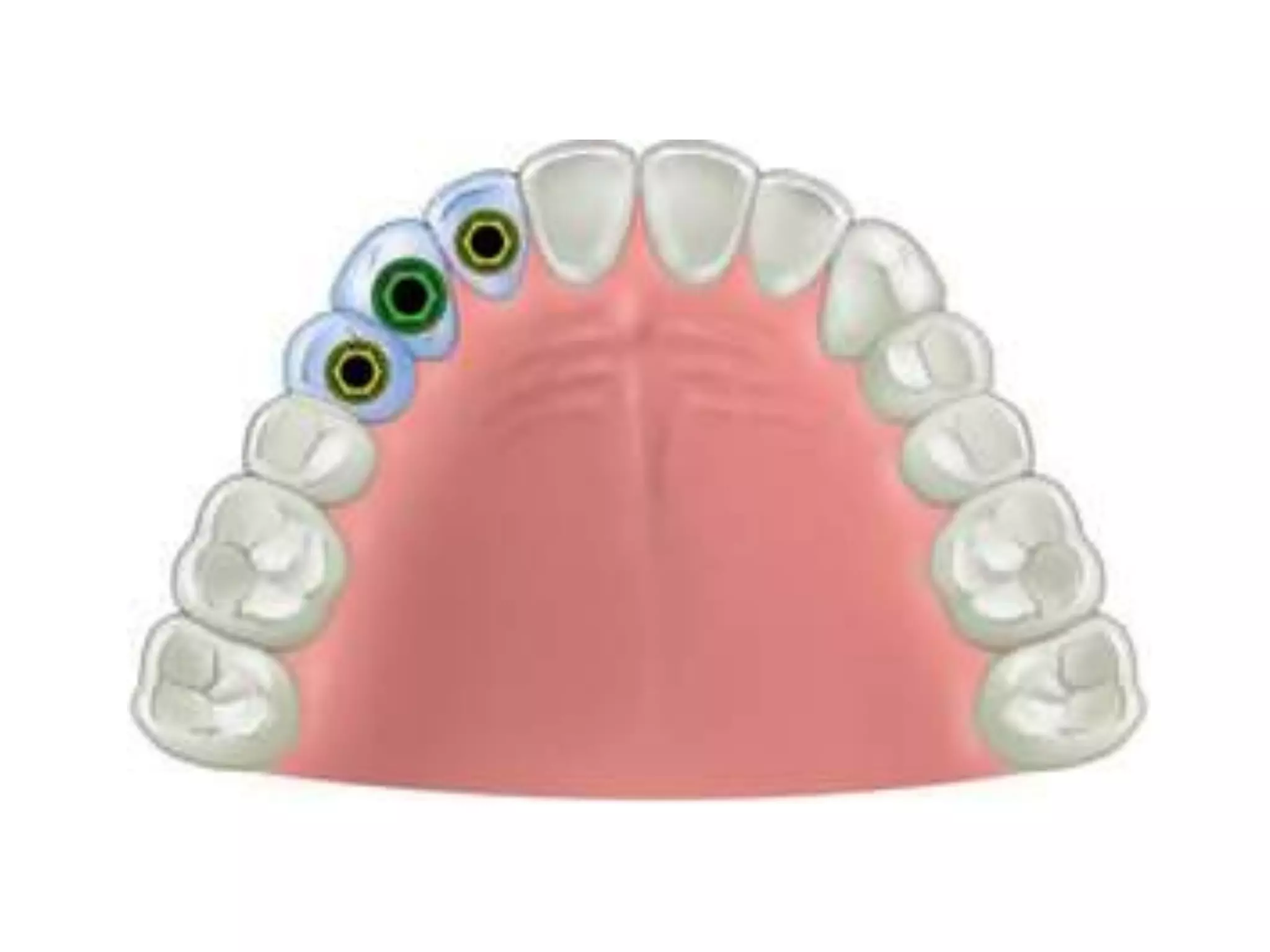 implant placement protocol where and when | PPTX