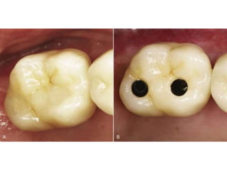 implant placement protocol where and when | PPTX
