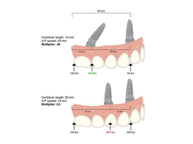 implant placement protocol where and when | PPTX | Bone and Joint ...