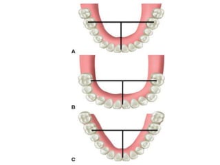 implant placement protocol where and when | PPTX