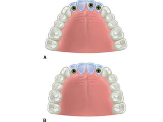 implant placement protocol where and when | PPTX