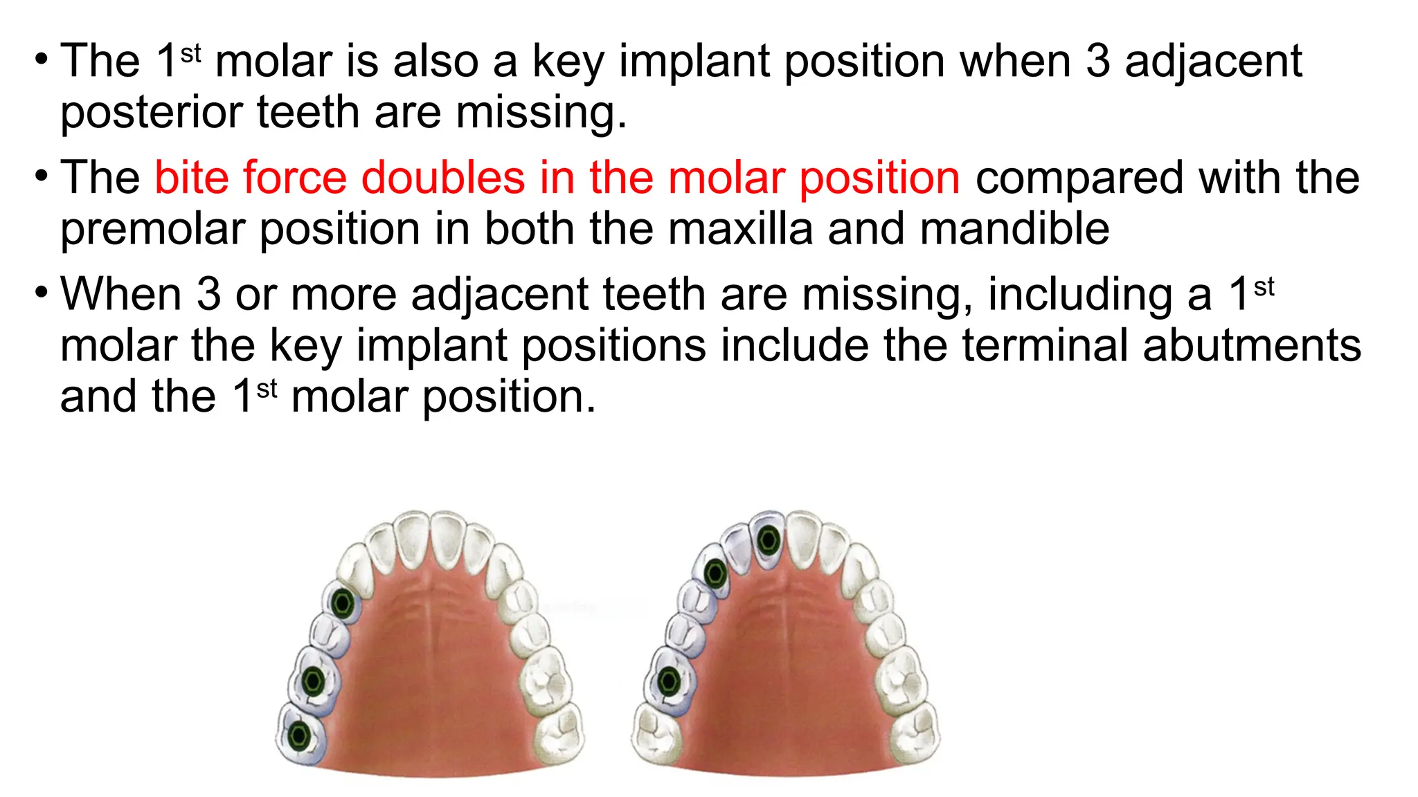 Treatment Plans Related to Key implant position and implant number - Dr ...