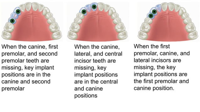 Treatment Plans Related to Key implant position and implant number - Dr ...