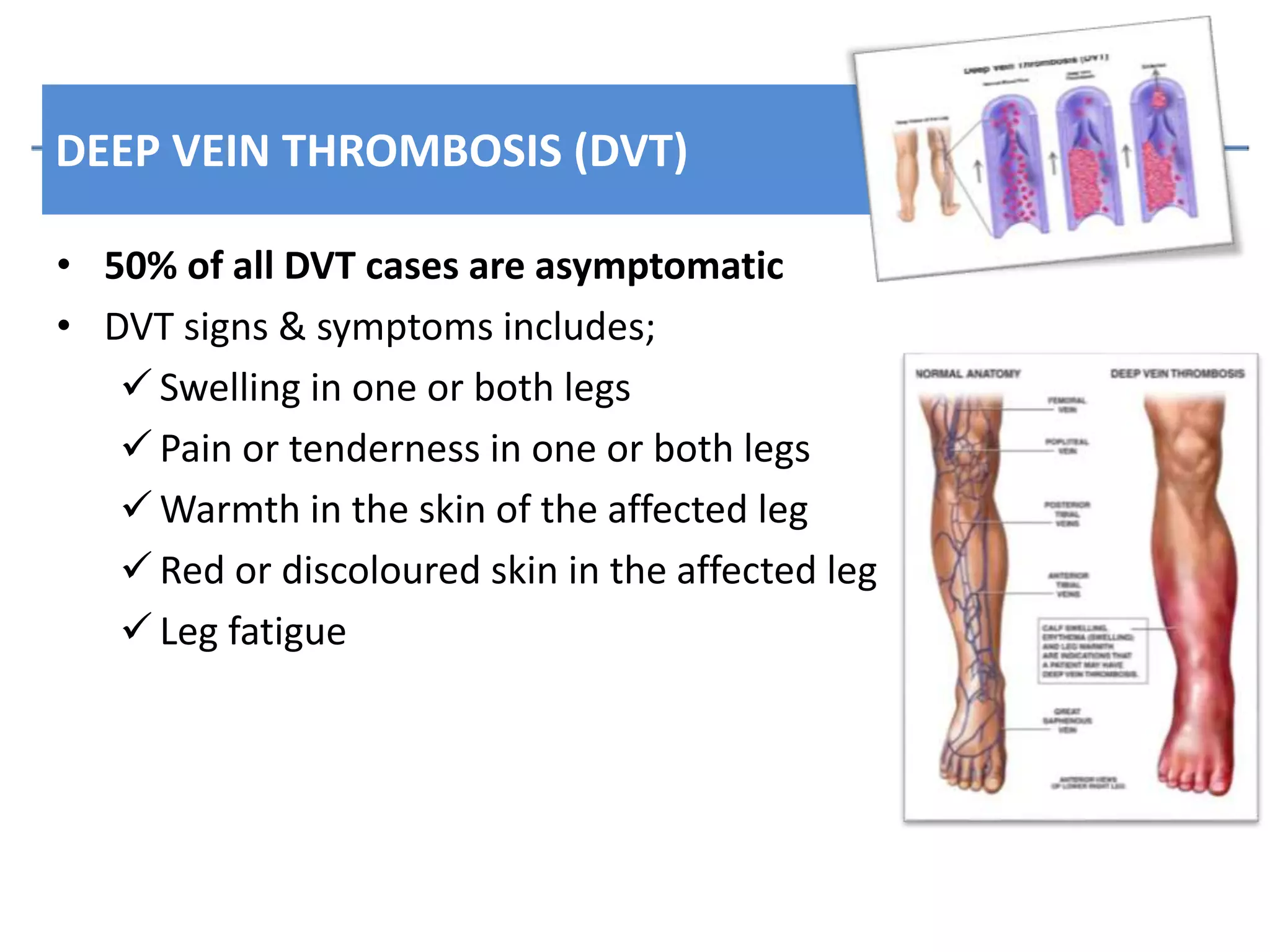 VTE in pregnancy and the puerperium | PPTX
