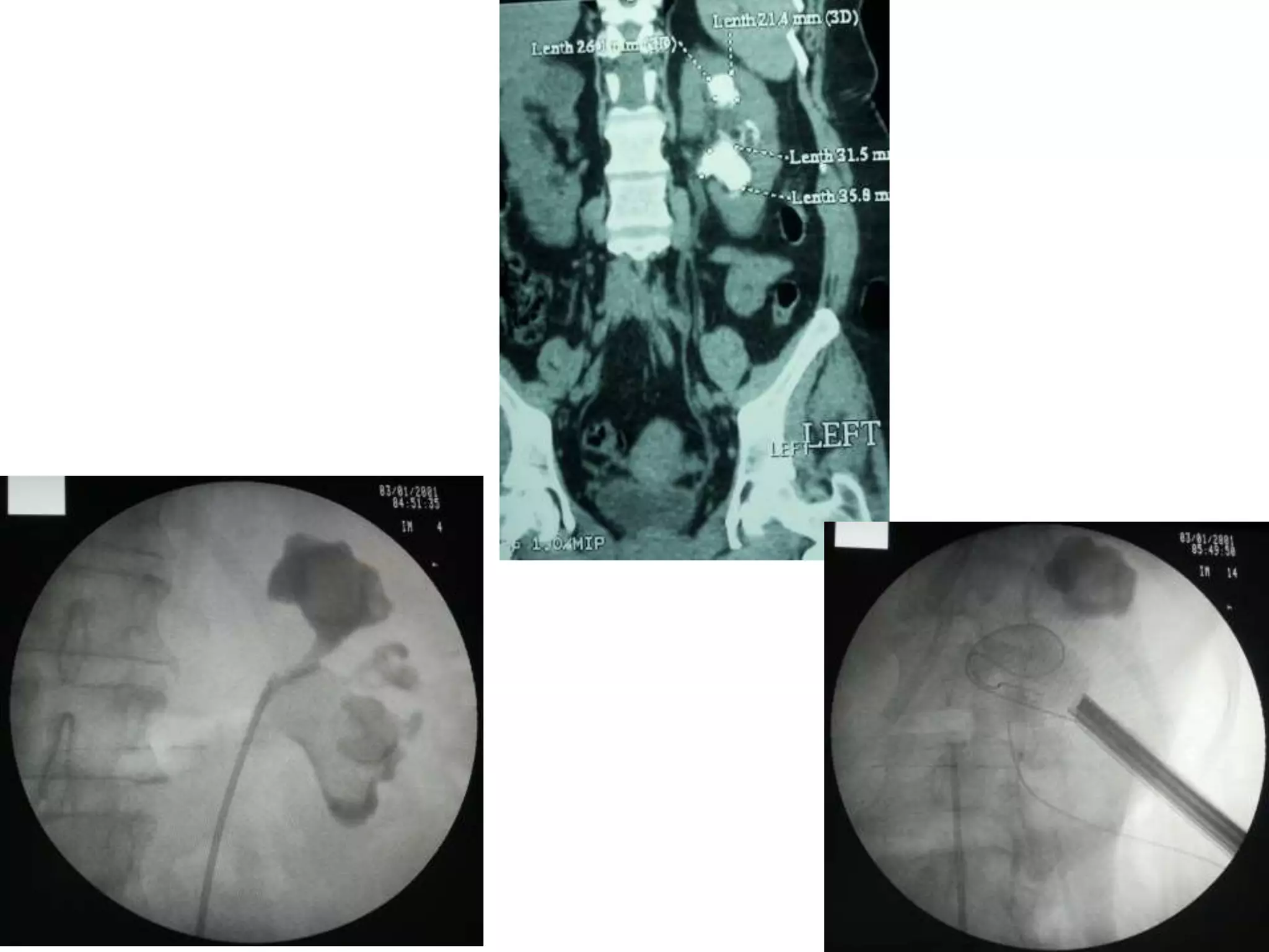 Treatment selection of renal calculi | PPTX | Surgery | Medical Health