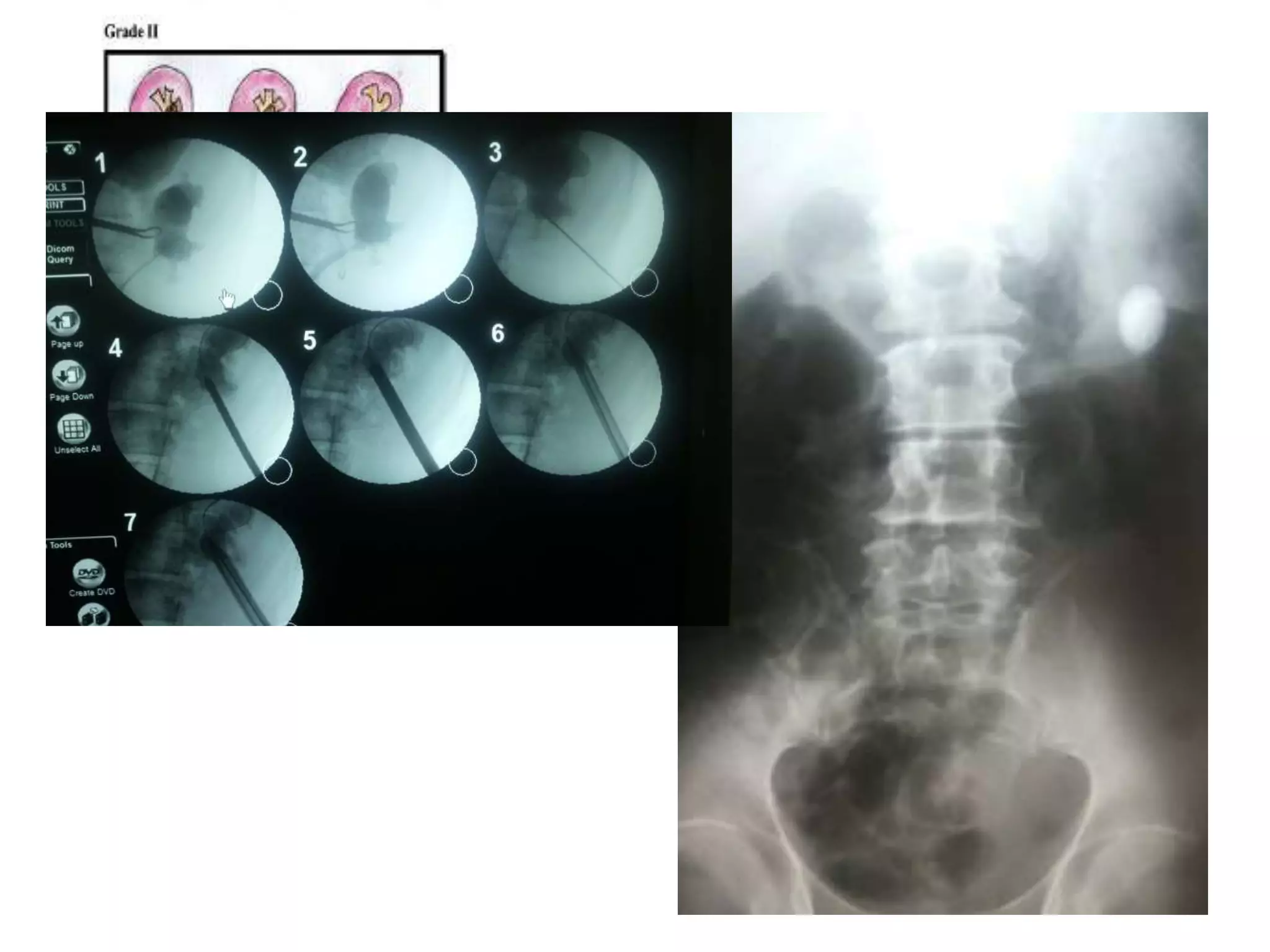 Treatment selection of renal calculi | PPTX | Surgery | Medical Health